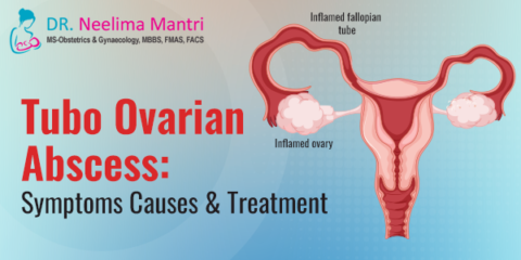 Tubo Ovarian Abscess: Symptoms Causes & Treatment