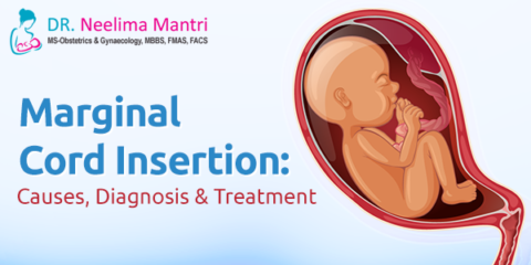 Marginal Cord Insertion: Causes, Diagnosis and Treatment